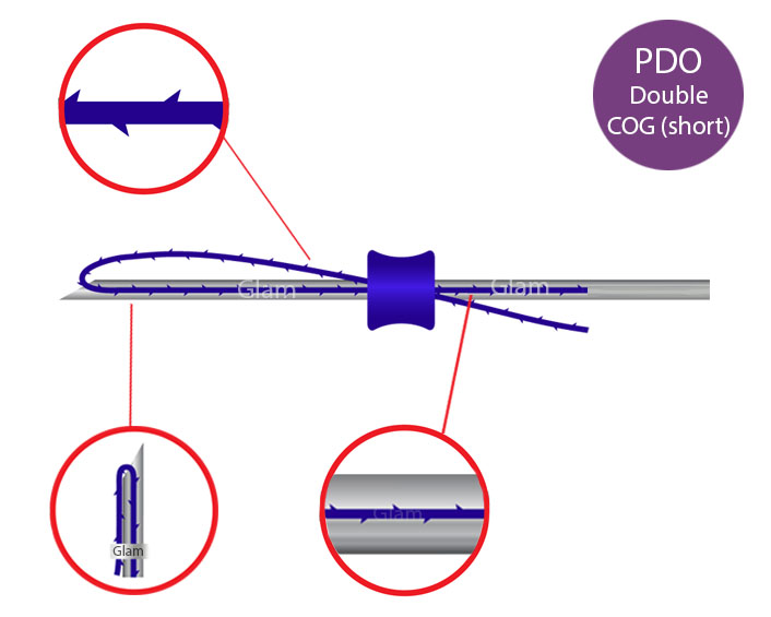 Glam Lifting Thread PDO Double Cog 23g 90mm 150mm - Buy Online | Glam Derma